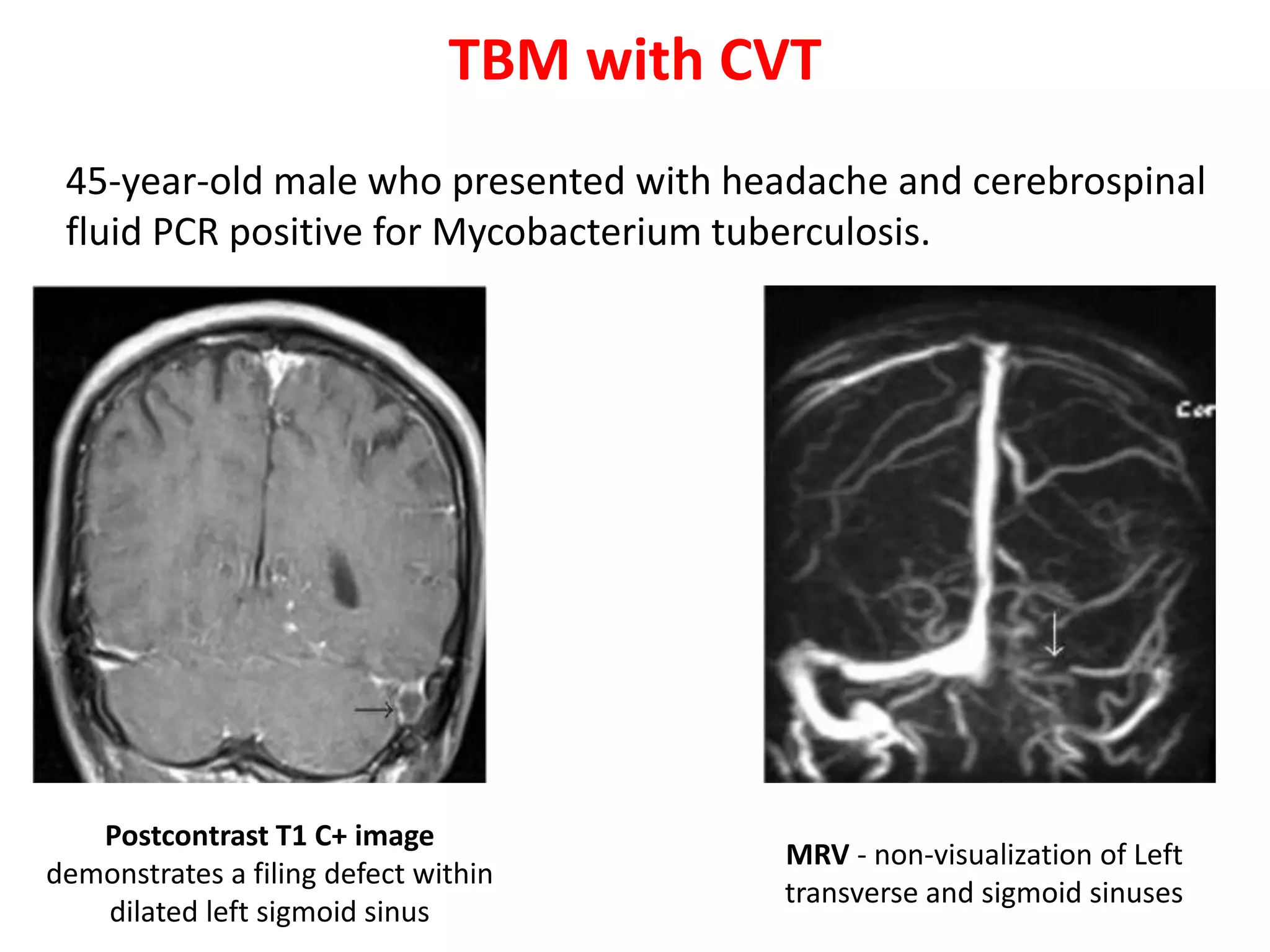 Imaging cns tb | PPTX
