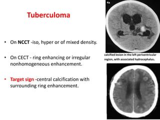 Imaging cns tb | PPTX
