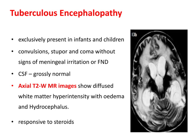Imaging cns tb | PPTX