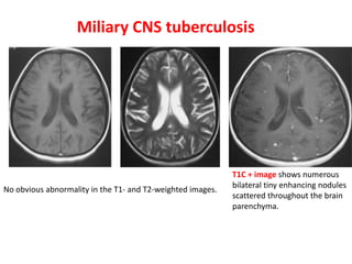 Imaging cns tb | PPTX
