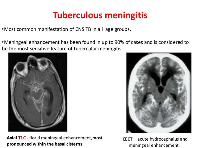 Imaging cns tb