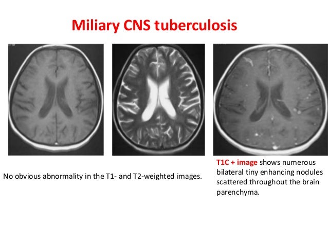 Imaging cns tb