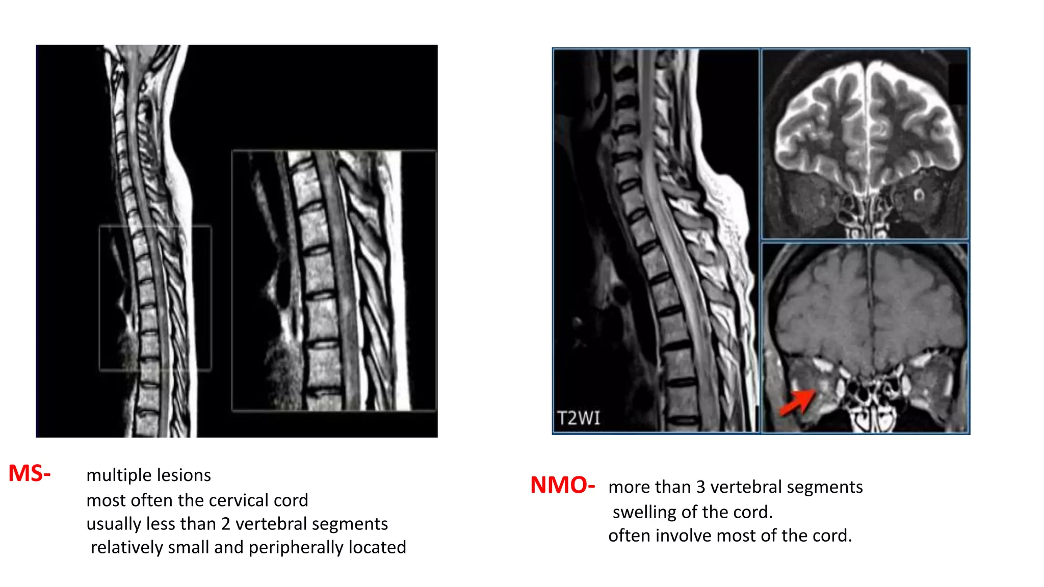 imaging in neurology - demyelinating diseases | PPTX