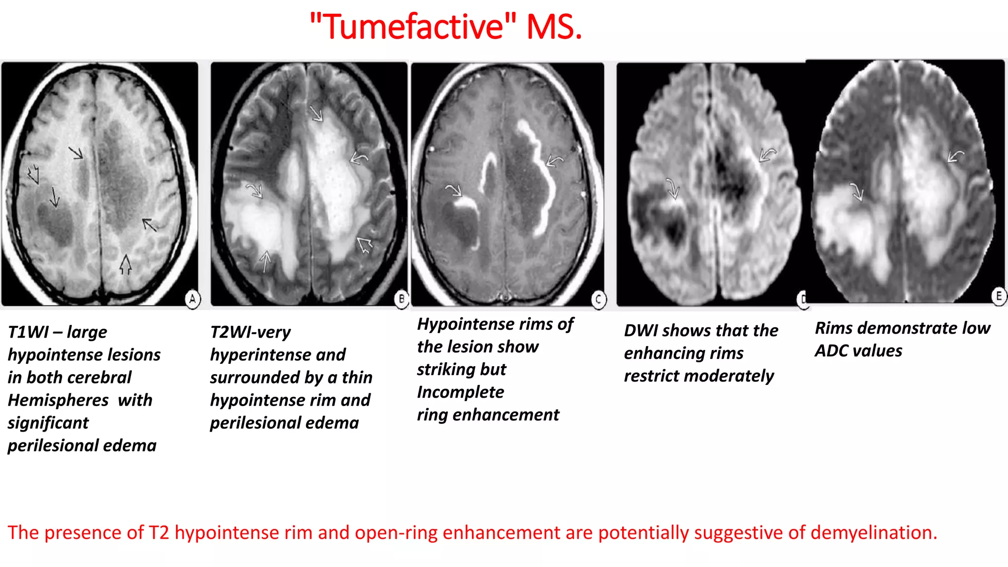 imaging in neurology - demyelinating diseases | PPTX
