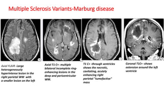 imaging in neurology - demyelinating diseases | PPTX