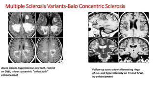imaging in neurology - demyelinating diseases | PPTX