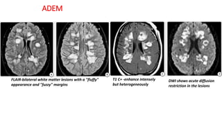 imaging in neurology - demyelinating diseases | PPTX