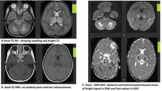 imaging in neurology - demyelinating diseases | PPTX