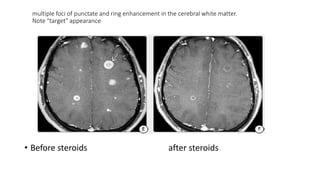 imaging in neurology - demyelinating diseases | PPTX