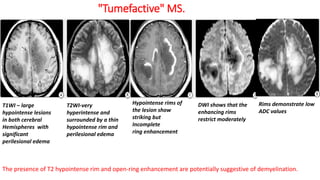 imaging in neurology - demyelinating diseases | PPTX