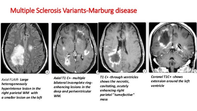 imaging in neurology - demyelinating diseases