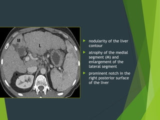Imaging features of hepatobiliary and pancretic ds | PPT