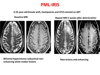 Imaging hiv | PPTX