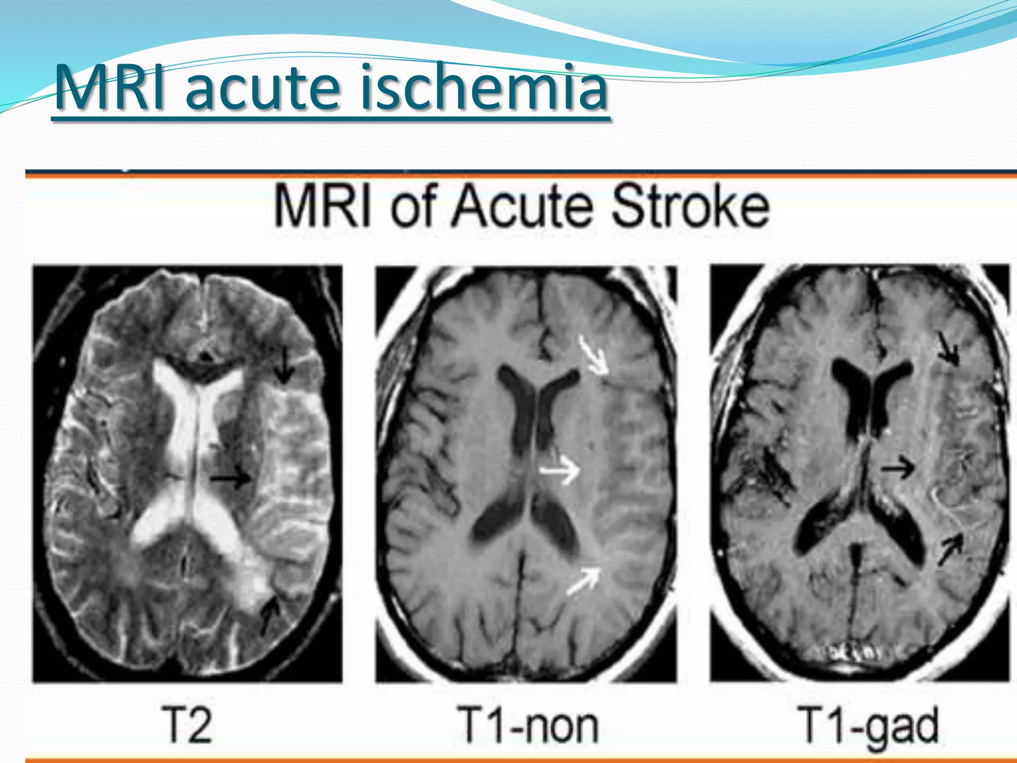 Imaging in ischemic stroke | PPTX