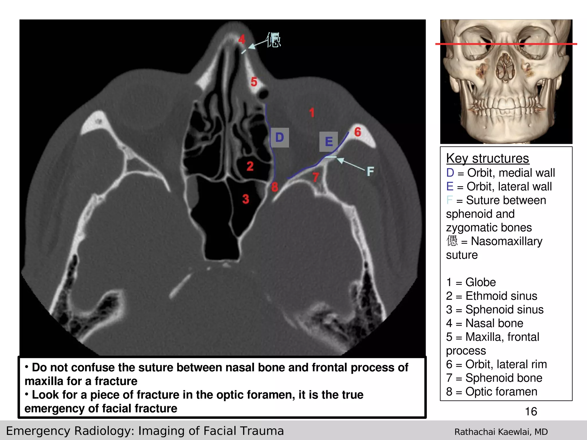 Imaging Of Facial Trauma Part 1 | PDF