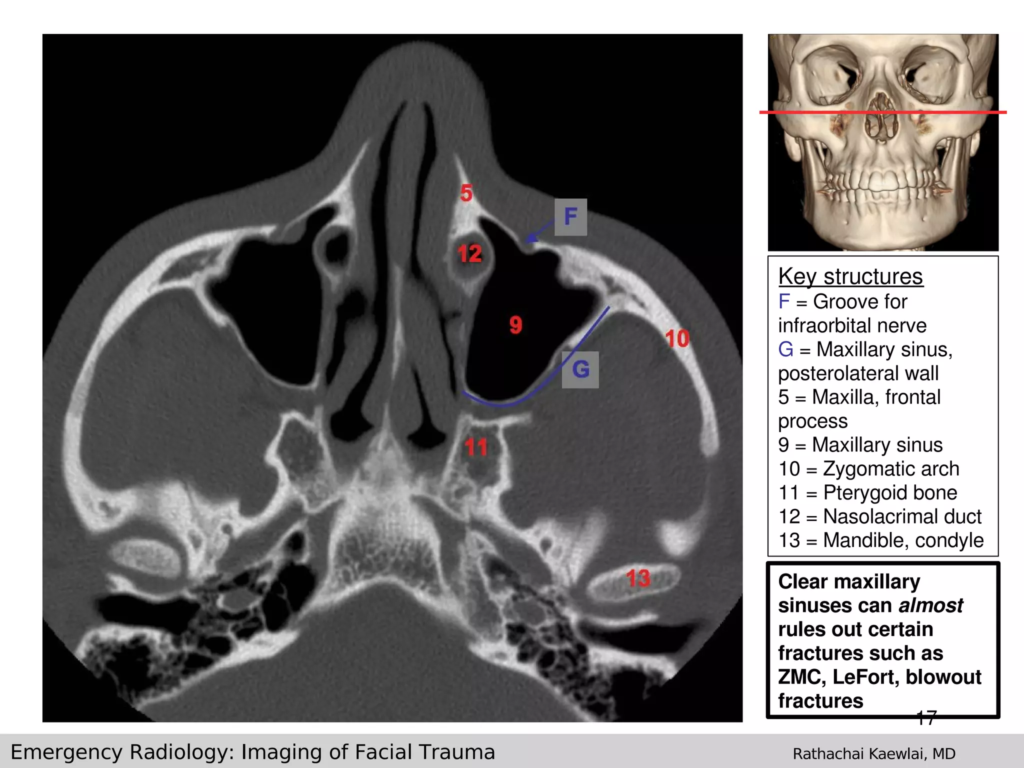 Imaging Of Facial Trauma Part 1 | PDF