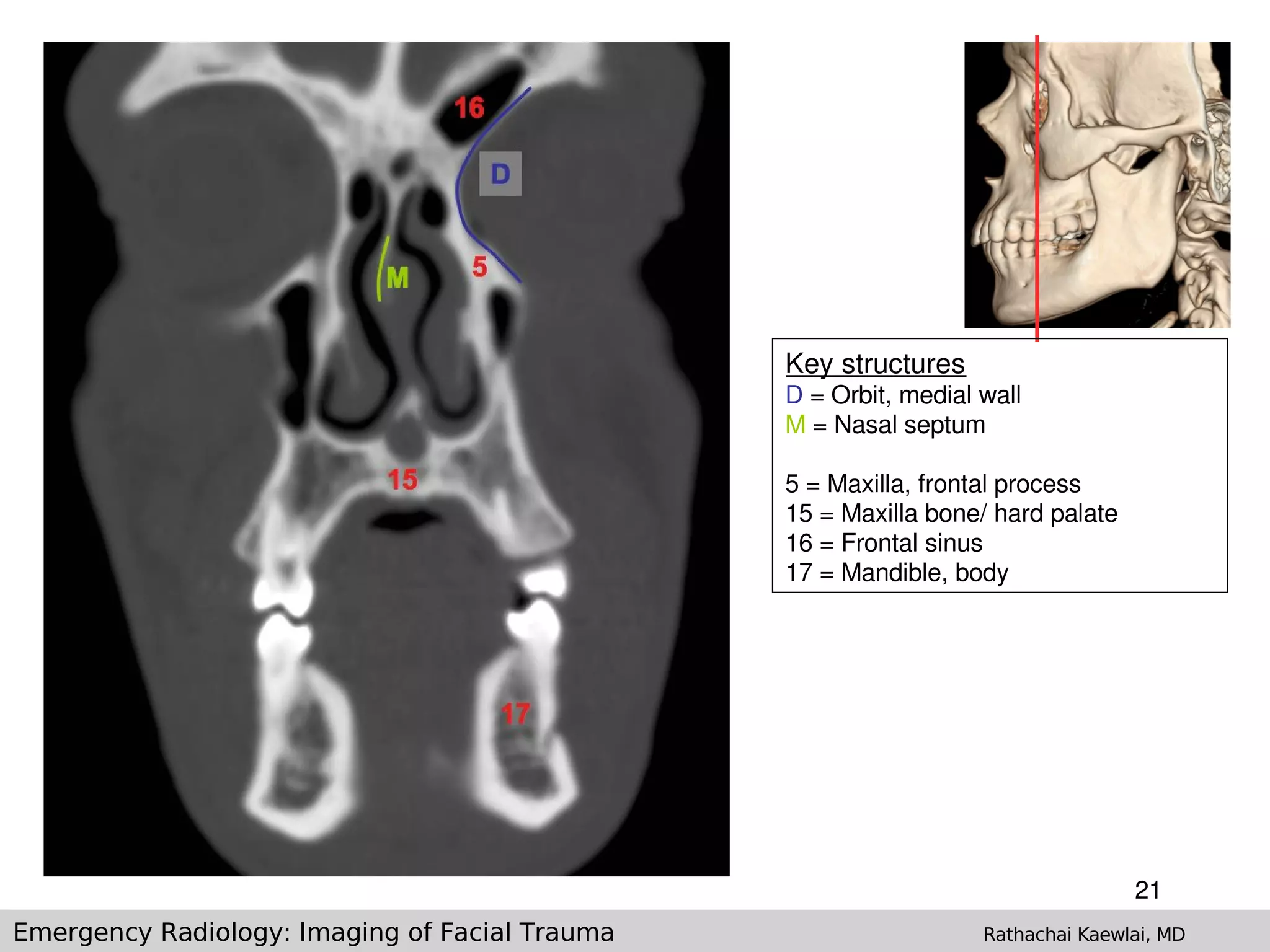 Imaging Of Facial Trauma Part 1 | PDF