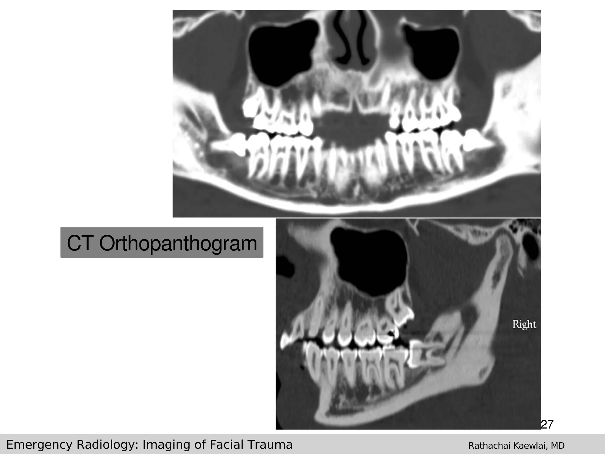 Imaging Of Facial Trauma Part 1 | PDF