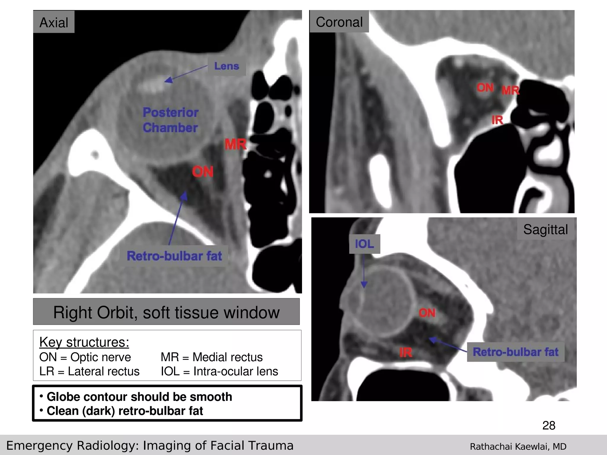 Imaging Of Facial Trauma Part 1 | PDF