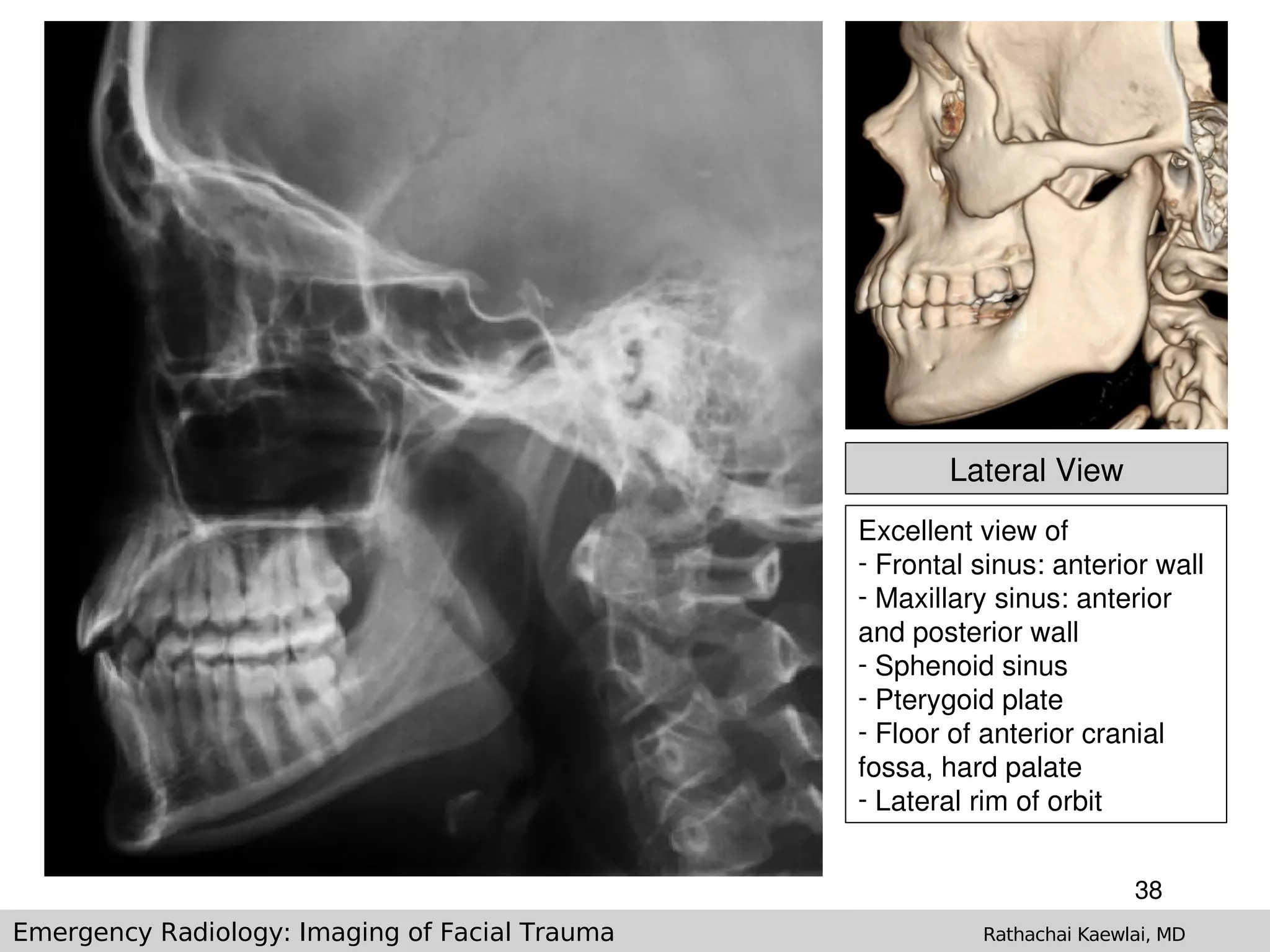 Imaging Of Facial Trauma Part 1 | PDF
