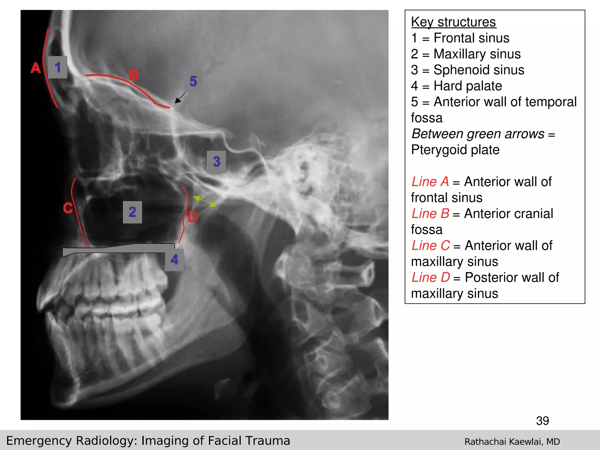 Imaging Of Facial Trauma Part 1 | PDF