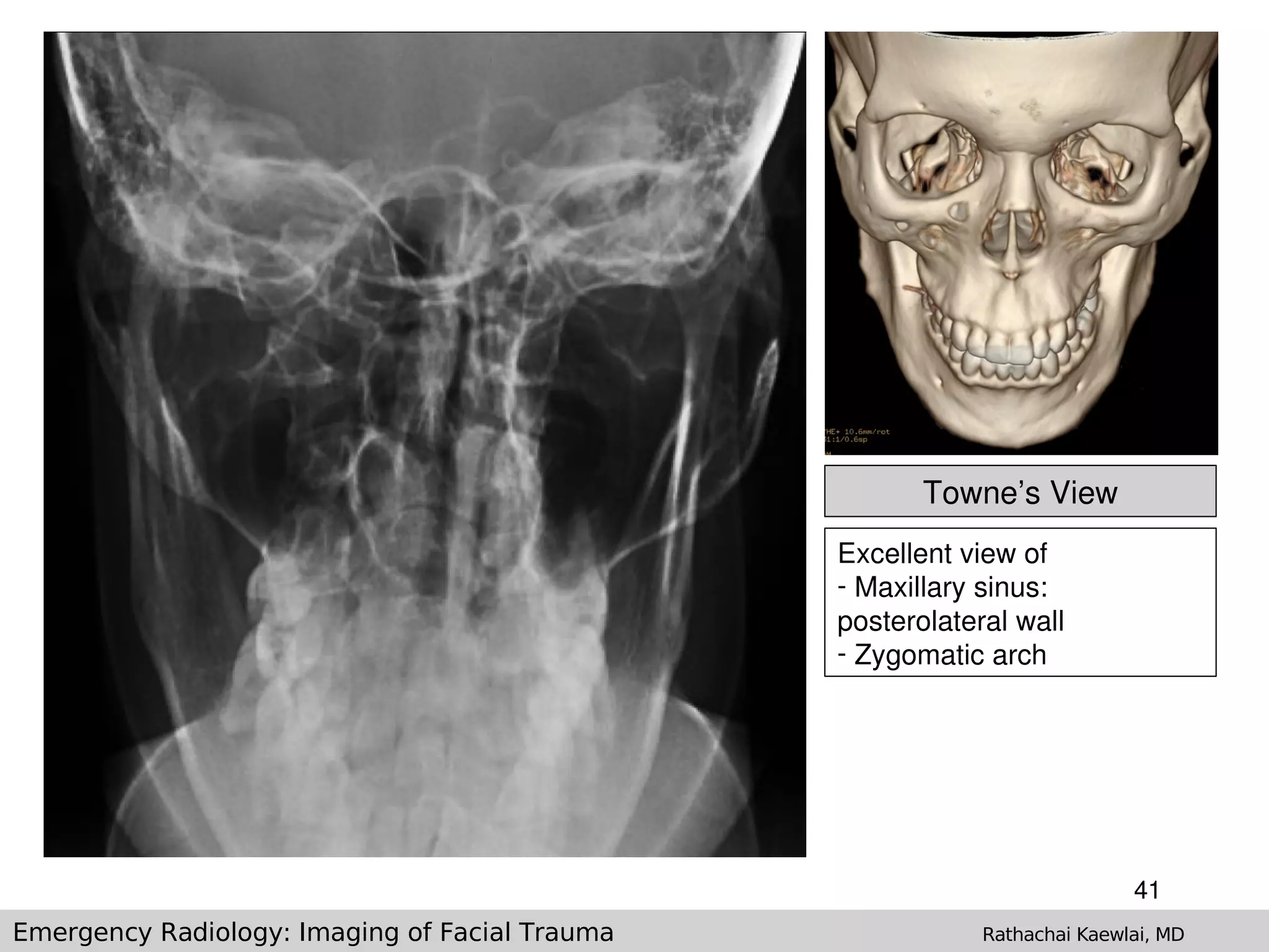 Imaging Of Facial Trauma Part 1 | PDF