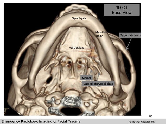 Imaging Of Facial Trauma Part 1 | PDF