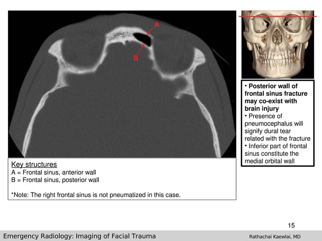 Imaging Of Facial Trauma Part 1 | PDF