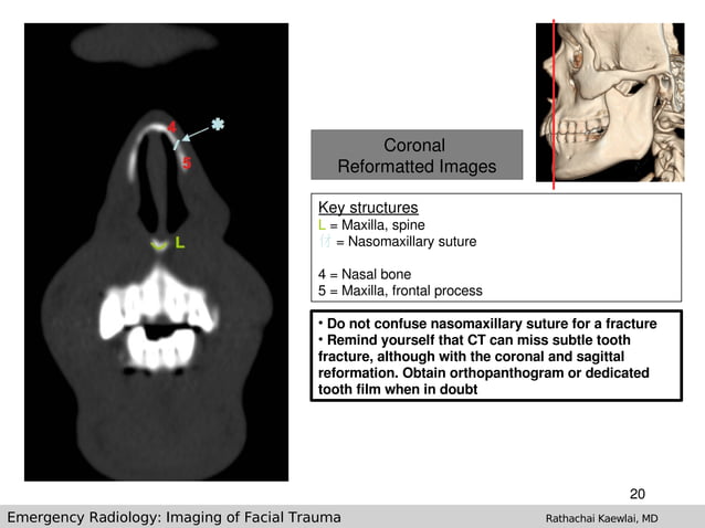 Imaging Of Facial Trauma Part 1 | PDF