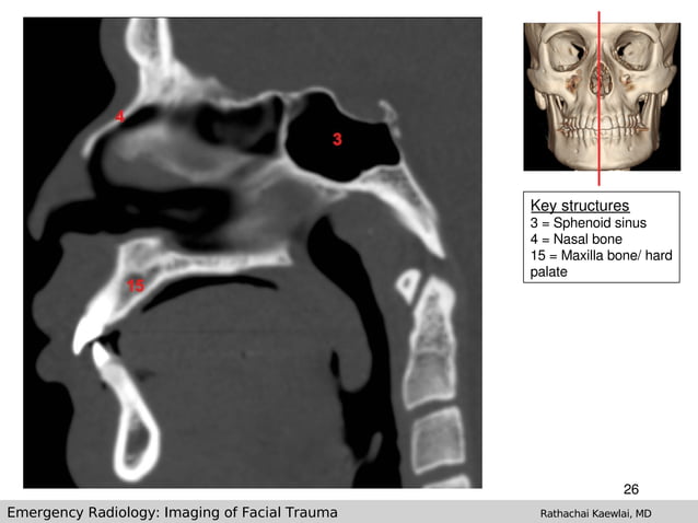 Imaging Of Facial Trauma Part 1 | PDF