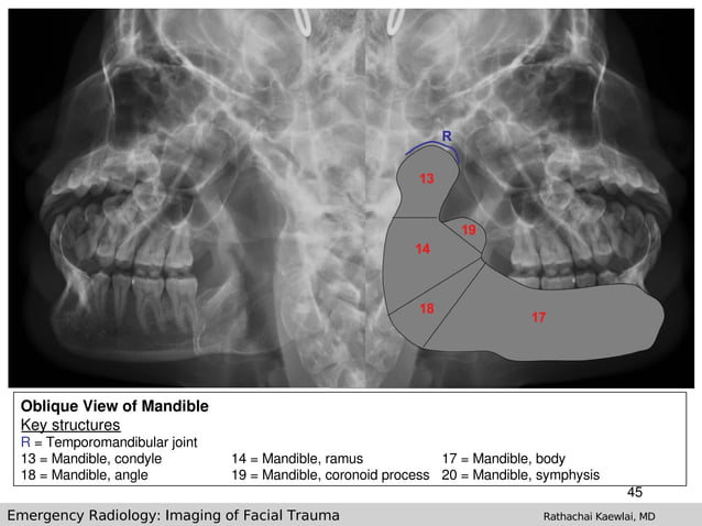 Imaging Of Facial Trauma Part 1 | PDF