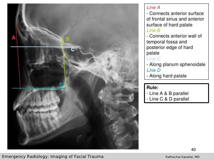 Imaging Of Facial Trauma Part 1