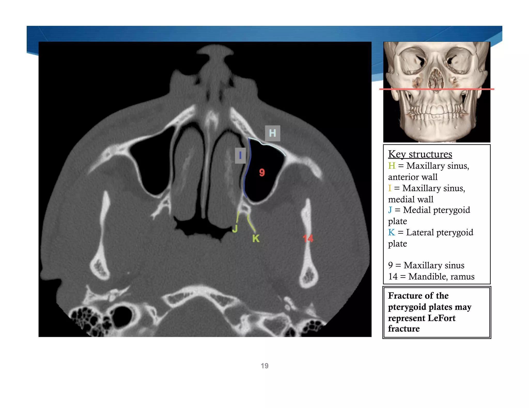 Imaging Of Facial Trauma Part 1 | PDF