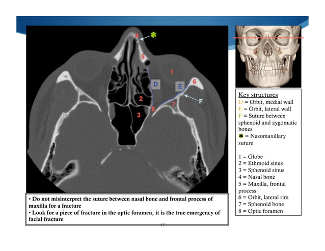 Imaging Of Facial Trauma Part 1 | PDF | Death, Injury, or Military ...