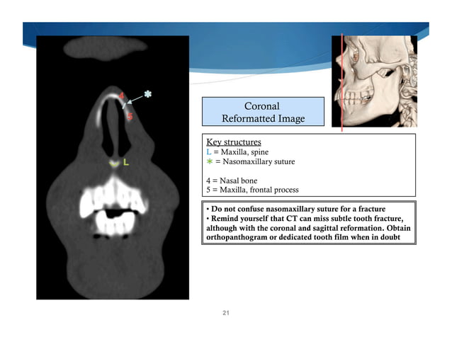 Imaging Of Facial Trauma Part 1 | PDF | Death, Injury, or Military ...