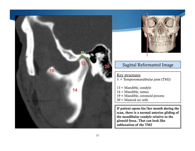 Imaging Of Facial Trauma Part 1 | PDF | Death, Injury, or Military ...