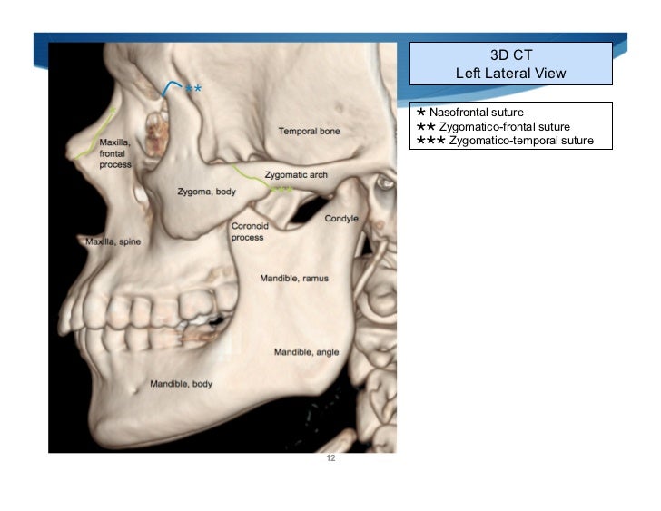 Imaging Of Facial Trauma Part 1