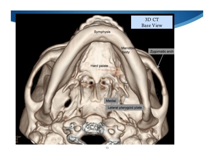 Zygomaticofrontal Suture Ct