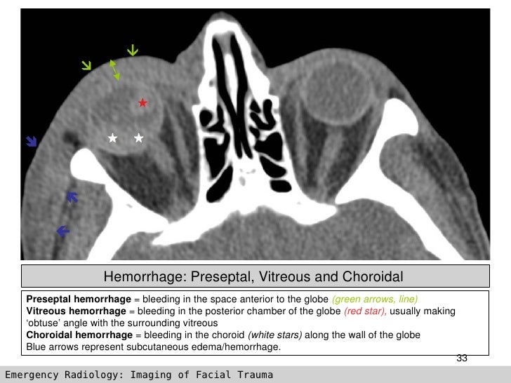Imaging Of Facial Trauma Part 2