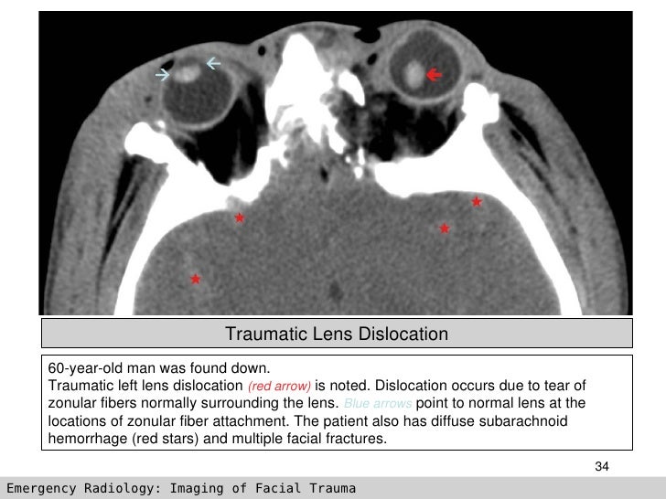 Imaging Of Facial Trauma Part 2