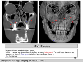 Imaging Of Facial Trauma Part 3 | PDF