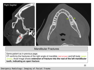 Imaging Of Facial Trauma Part 3 | PDF