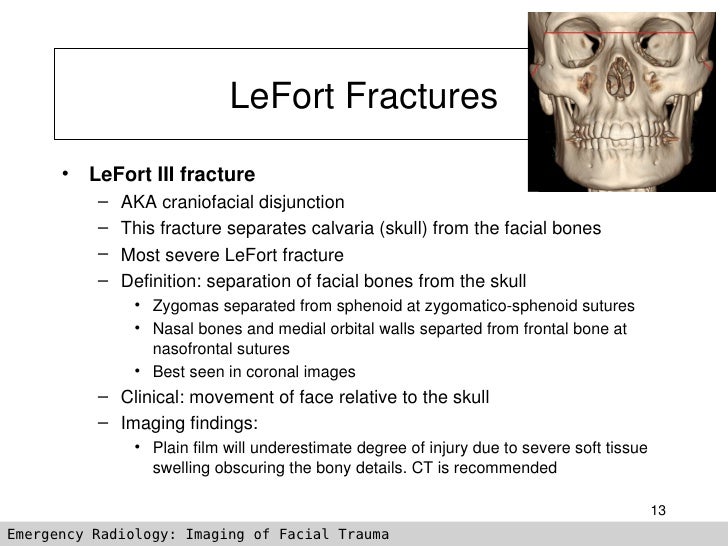 Imaging Of Facial Trauma Part 3