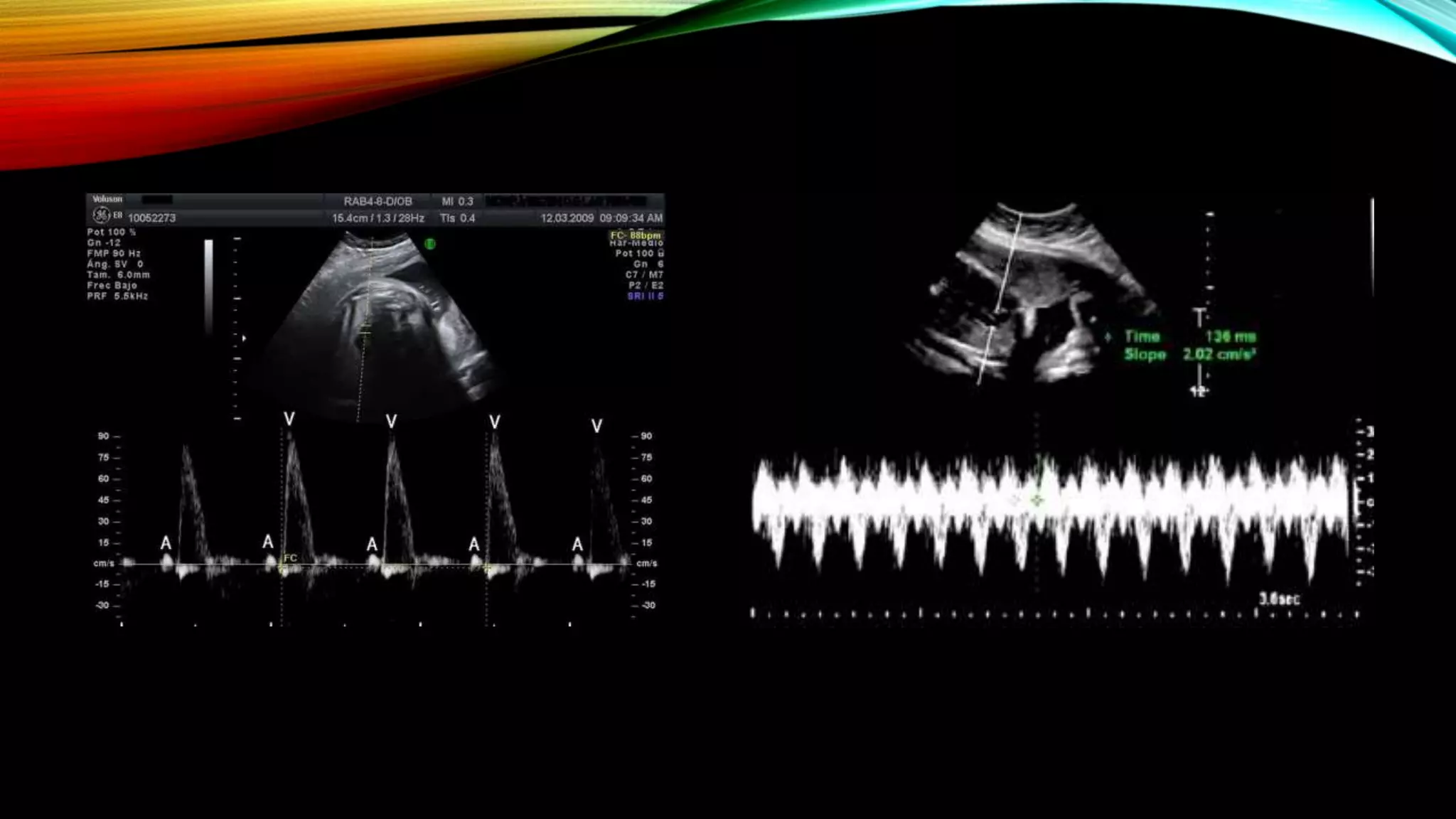IMAGING OF FETAL CVS AND ITS ANOMALIES | PPTX
