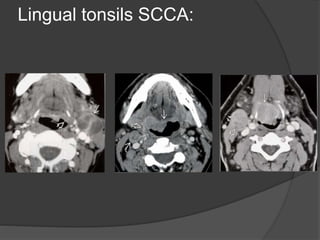 Lingual Tonsils Mri
