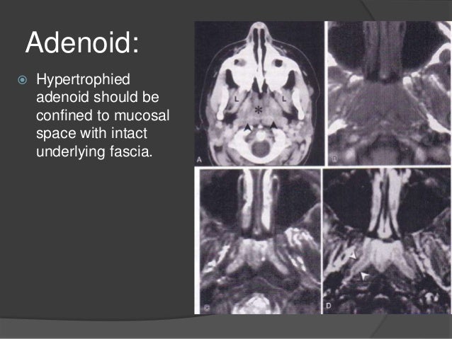 Imaging of the neck part ii