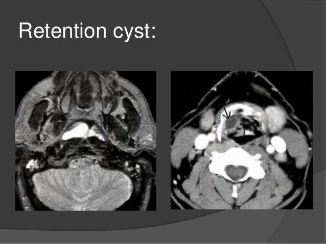 Imaging of the neck part ii