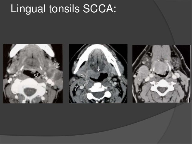 Normal Tonsils Vs Abnormal