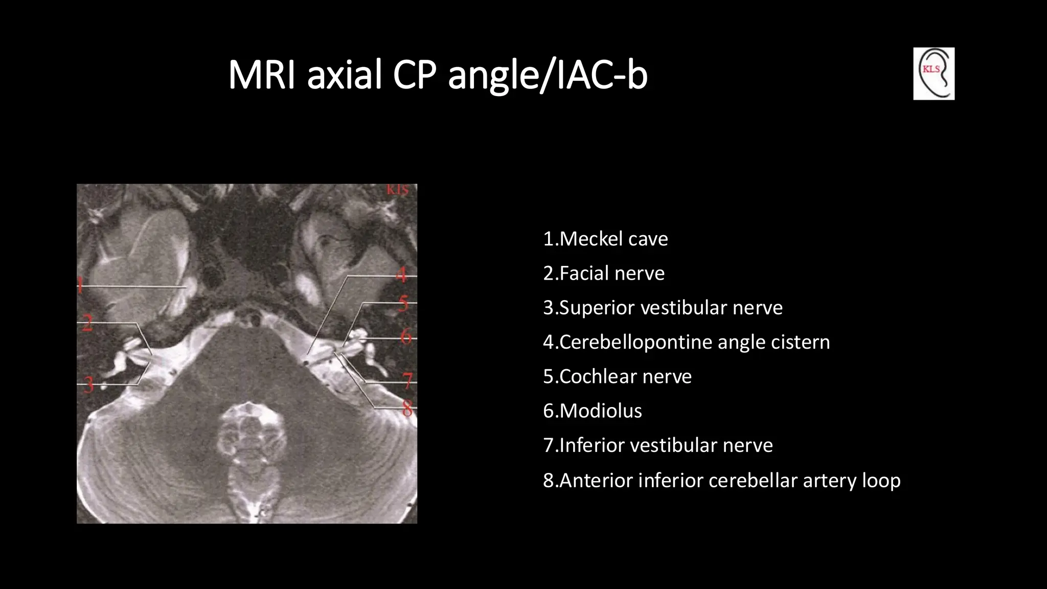 Quiz :Imaging of the Temporal Bone Anatomy | PDF