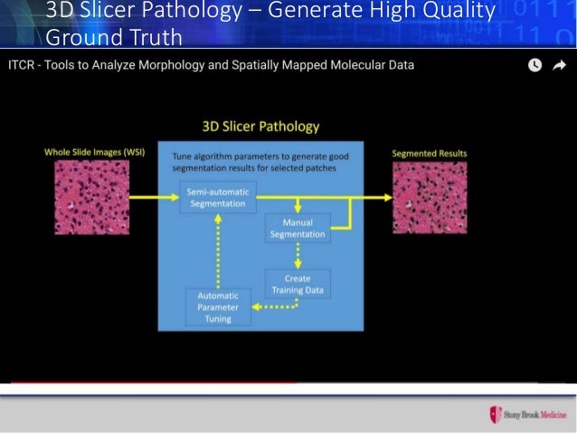 Pathomics Based Biomarkers and Precision Medicine